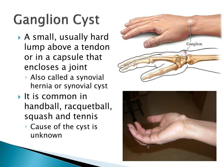 What Is A Ganglion Cyst Of The Elbow at Michael Schiller blog