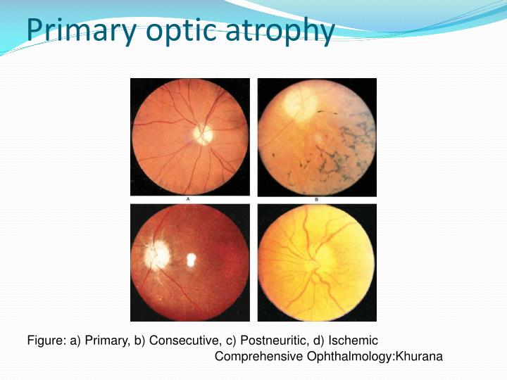 PPT - OPTIC NERVE : APPLIED ANATOMY, CLINICAL EVALUATION AND APPROACHES ...