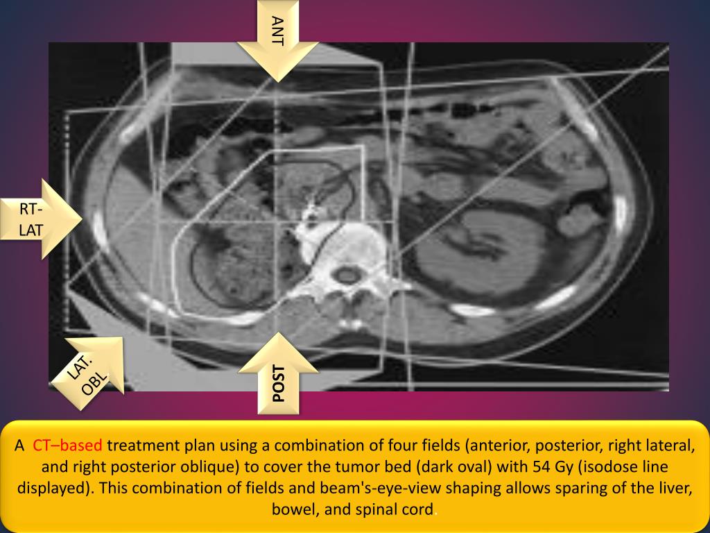 PPT - Radiotherapy in Renal Cell Carcinoma PowerPoint Presentation ...