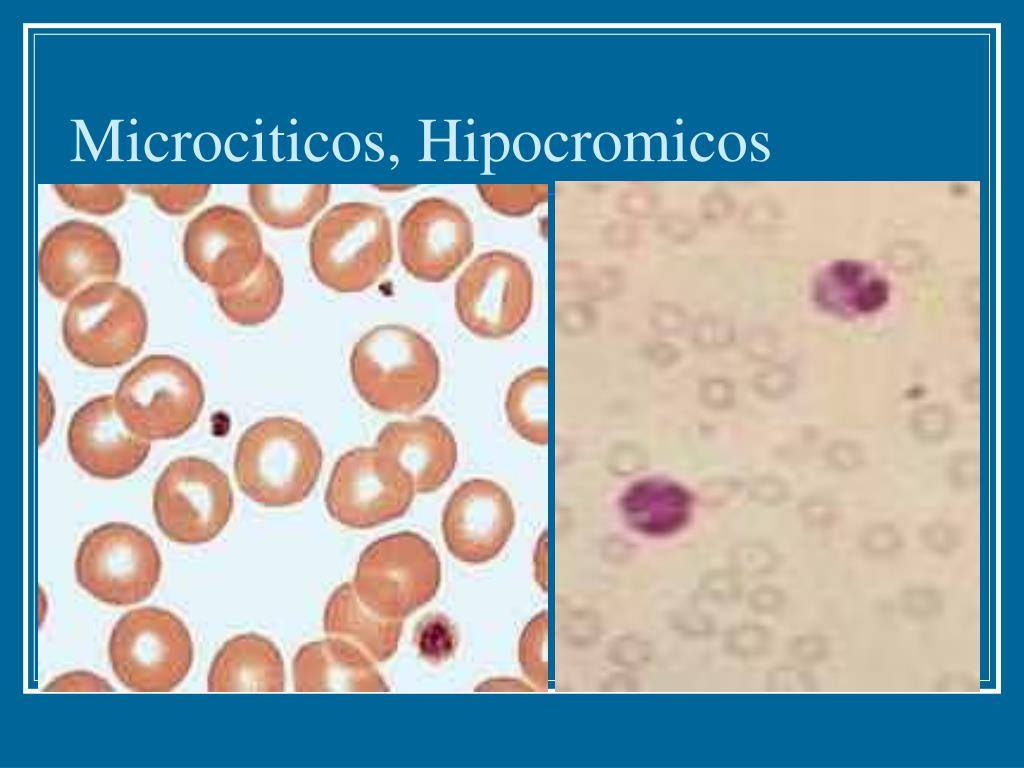PPT - Enfermedad de los Hematies y Trastornos Hemorragicos PowerPoint ...