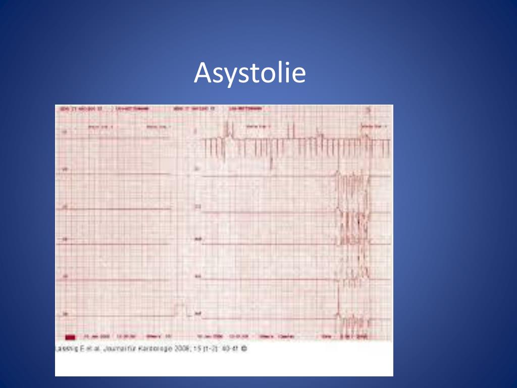 PPT - Herzlich Willkommen! zu: EKG verstehen und bewerten PowerPoint ...