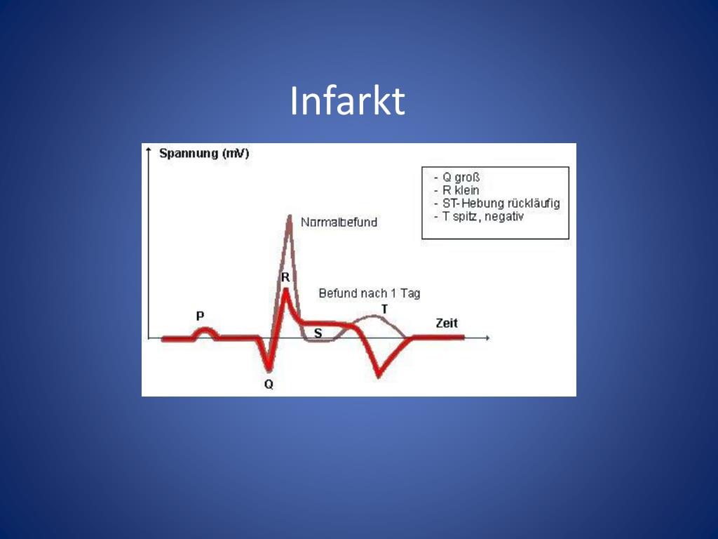 PPT - Herzlich Willkommen! zu: EKG verstehen und bewerten PowerPoint ...