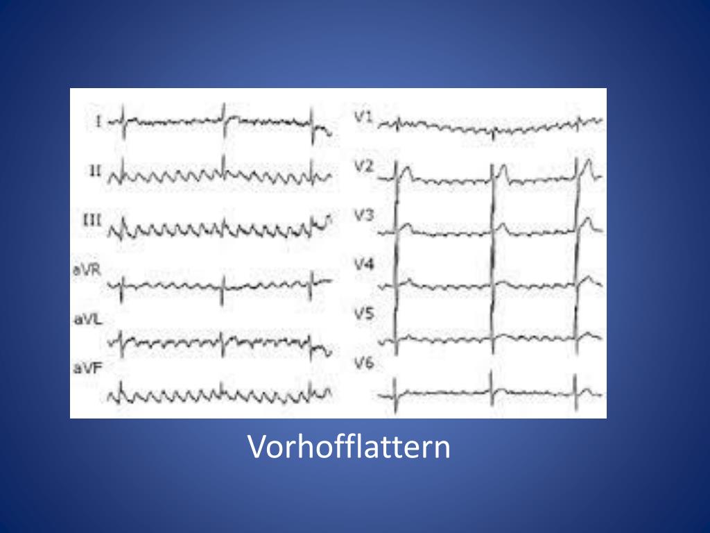 PPT - Herzlich Willkommen! zu: EKG verstehen und bewerten PowerPoint ...