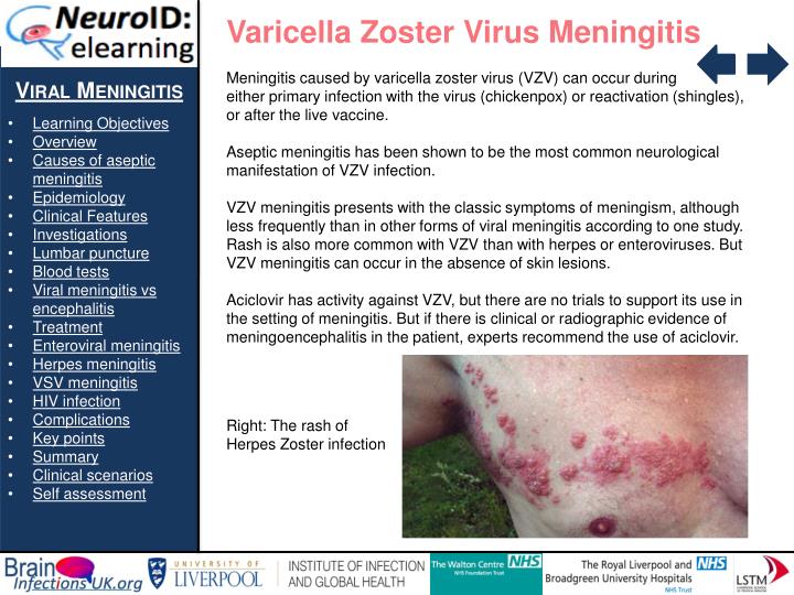PPT - Viral Meningitis Learning Objectives Overview Causes of aseptic ...