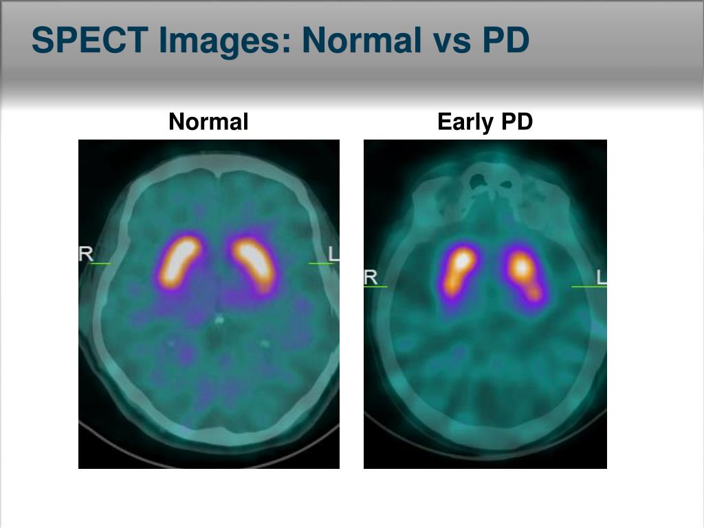 PPT - Is It Essential Tremor or a Parkinsonian Syndrome? PowerPoint ...