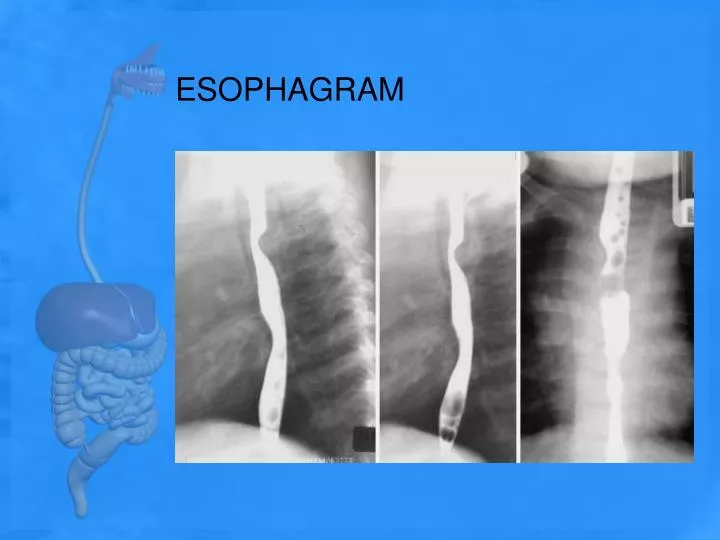PPT - ESOPHAGRAM PowerPoint Presentation, free download - ID:3086985