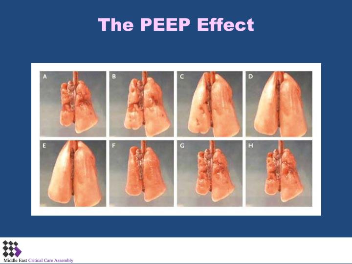 PPT - Complications of Mechanical Ventilation PowerPoint Presentation ...