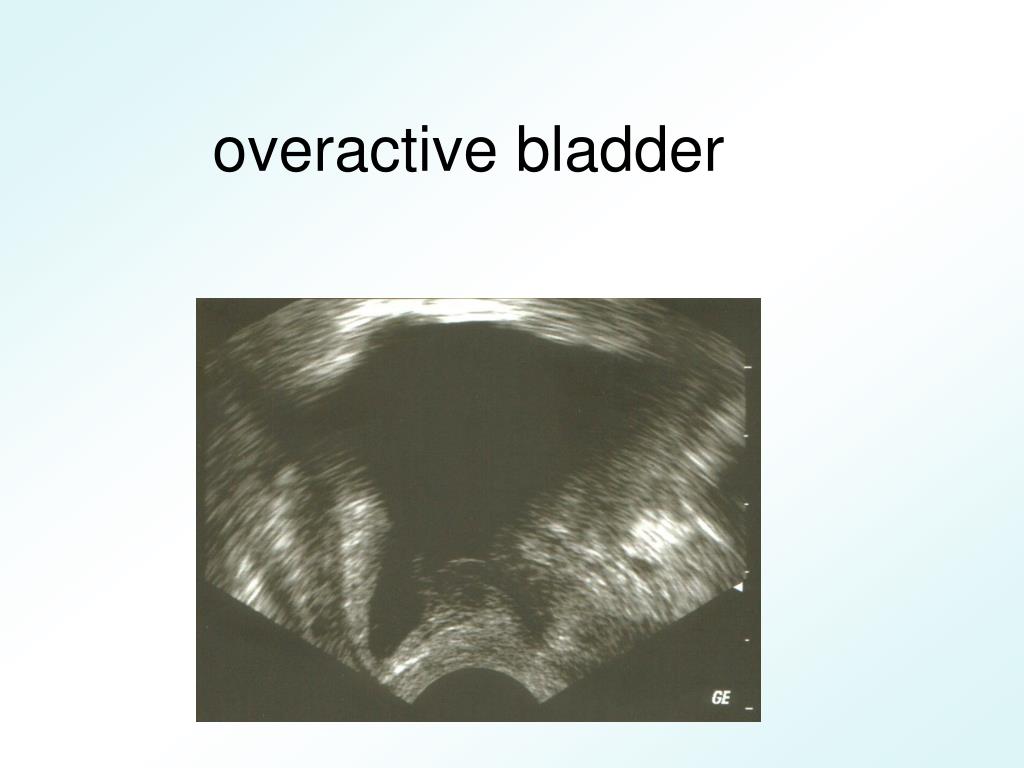 PPT - Ultrasonographic studies of the lower urinary Tract, Anorectal ...