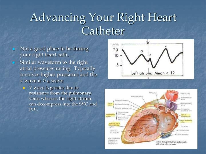 PPT - Right Heart Catheterization – basic right heart pressure tracings ...