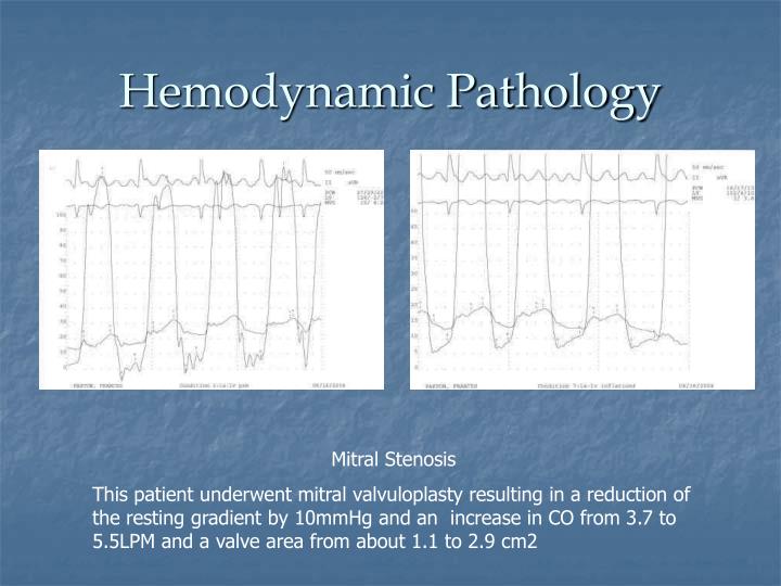 PPT - Right Heart Catheterization – basic right heart pressure tracings ...