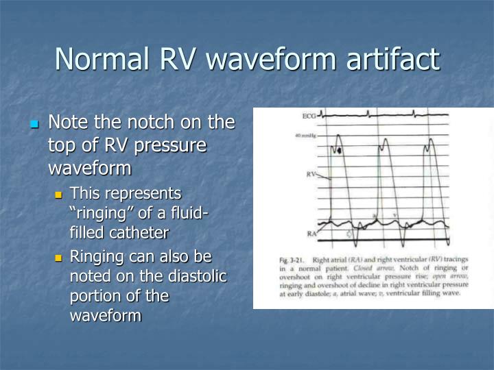 PPT - Right Heart Catheterization – basic right heart pressure tracings ...