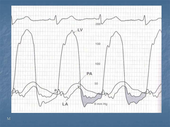 PPT - Right Heart Catheterization – basic right heart pressure tracings ...