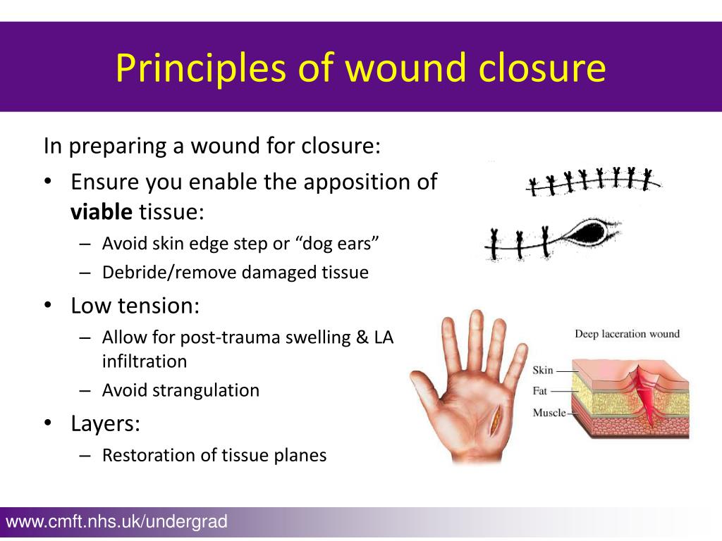 PPT - Suturing PowerPoint Presentation, free download - ID:3096480 PPT - Suturing PowerPoint Presentation, free download - ID:3096480