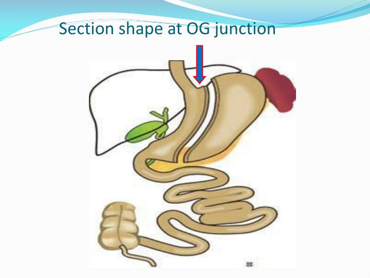 PPT - Laparoscopic Sleeve Gastrectomy PowerPoint Presentation - ID:3097830