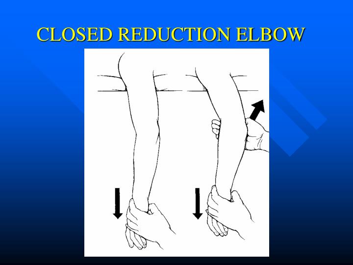 PPT - Fractures and dislocations of the shoulder girdle and elbow and ...