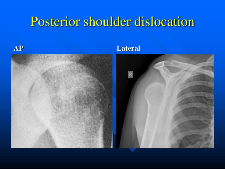 PPT - Fractures and dislocations of the shoulder girdle and elbow and ...