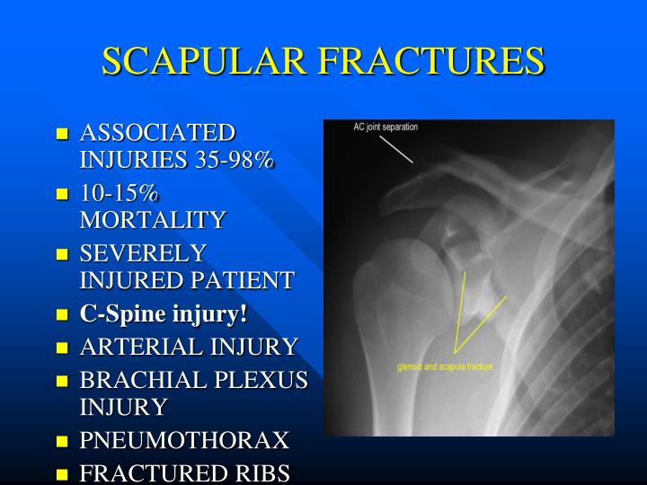 PPT - Fractures and dislocations of the shoulder girdle and elbow and ...