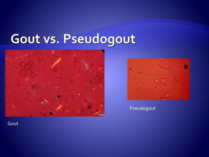 PPT - Arthrocentesis PowerPoint Presentation - ID:3101717