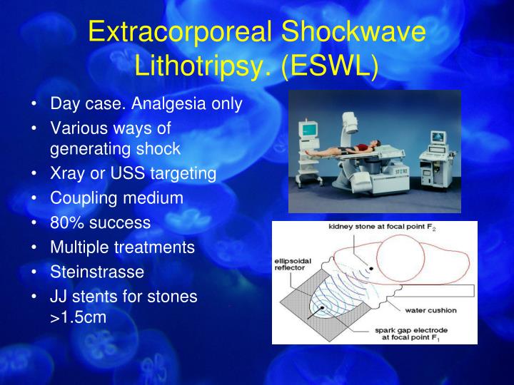 PPT - Ureteric colic and Urinary tract stones PowerPoint Presentation - ID:3101944