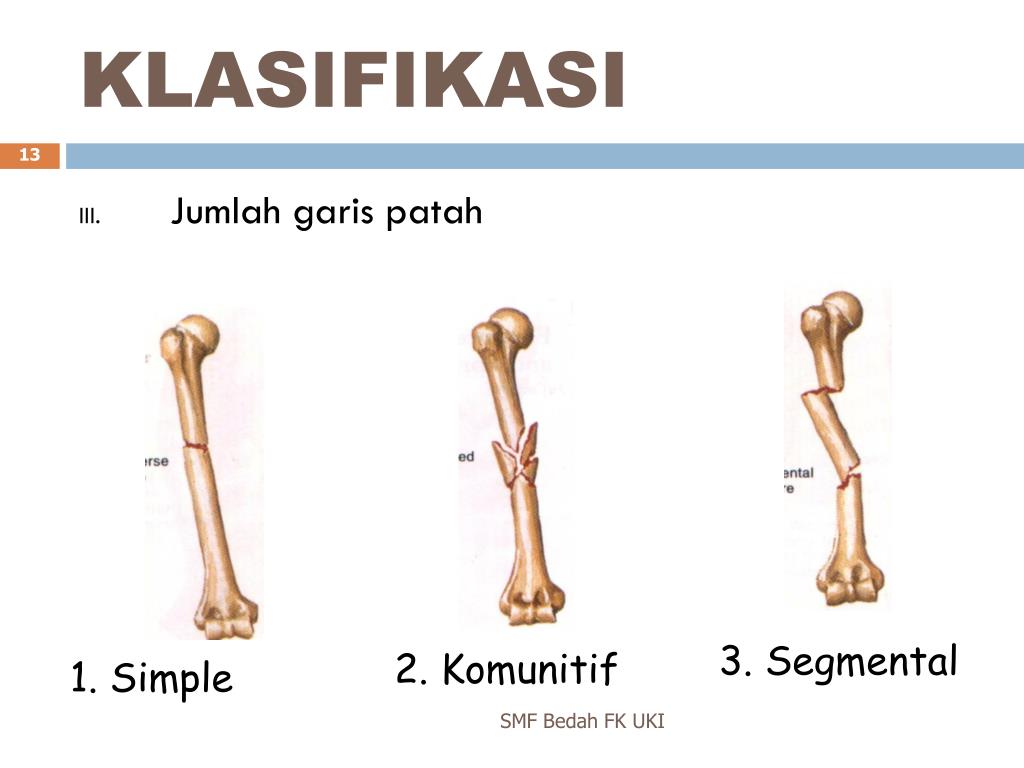 PPT - FRAKTUR UMUM dr. Wahyu Eko W, SpOT ORTHOPAEDI DAN TULANG BELAKANG ...