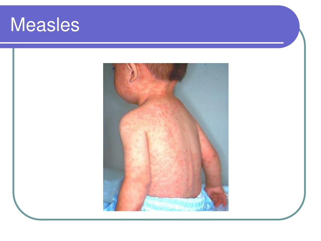 PPT - Viral infection of the skin & mucous membrane PowerPoint ...
