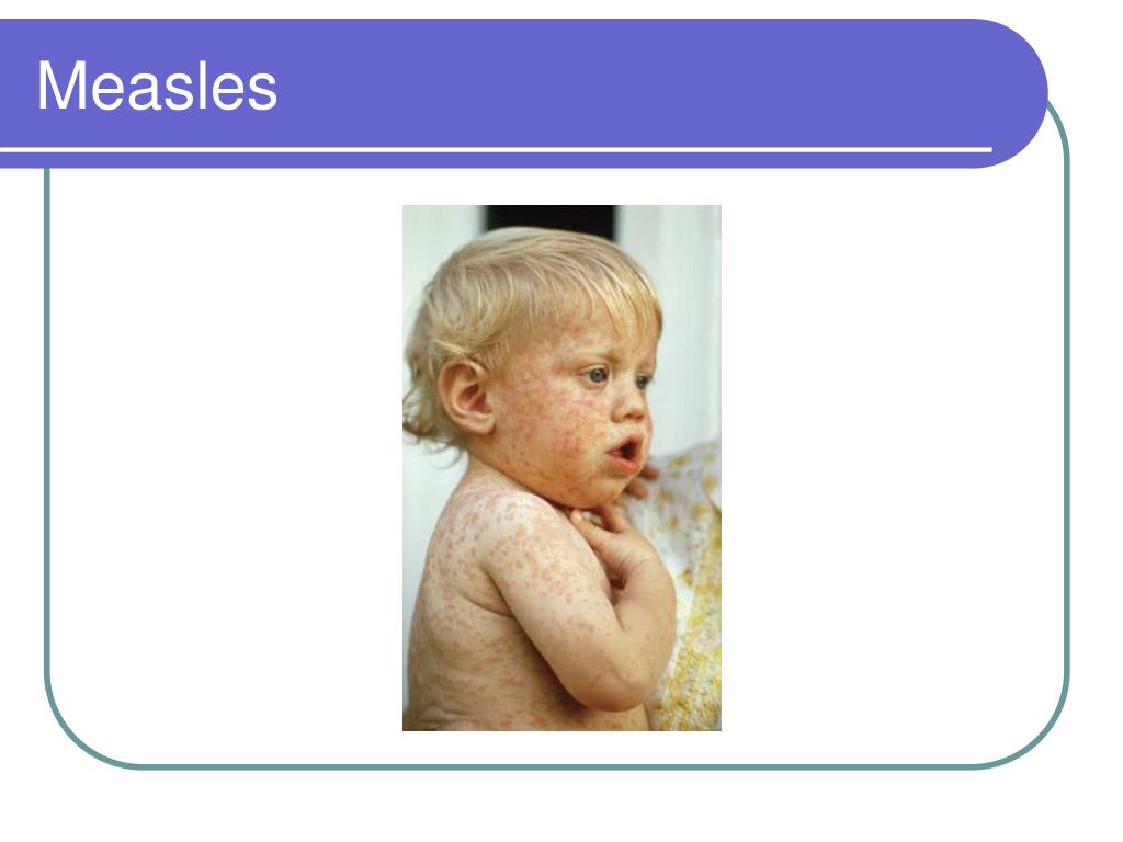 PPT - Viral infection of the skin & mucous membrane PowerPoint ...