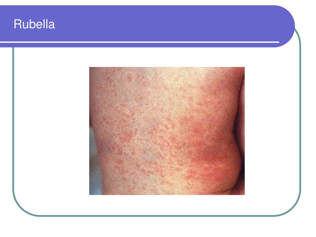 PPT - Viral infection of the skin & mucous membrane PowerPoint ...