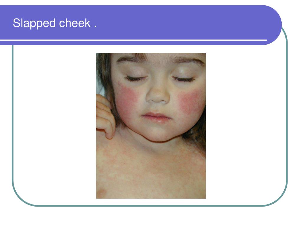 PPT - Viral infection of the skin & mucous membrane PowerPoint ...