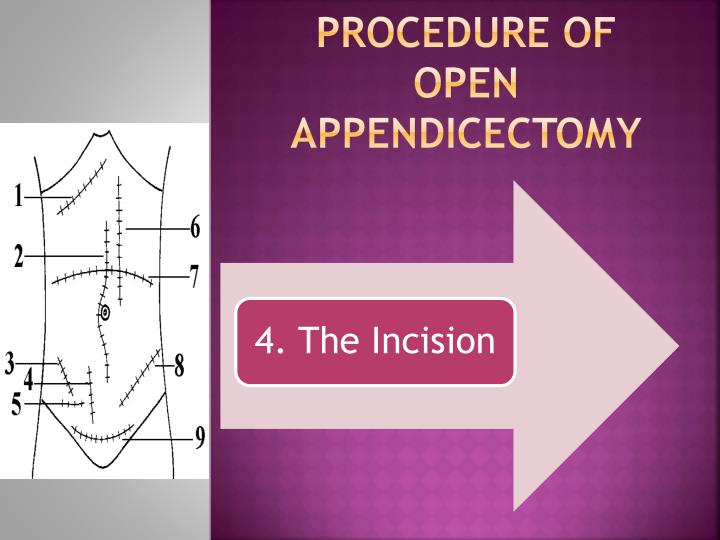 PPT - Appendicectomy PowerPoint Presentation - ID:3112134