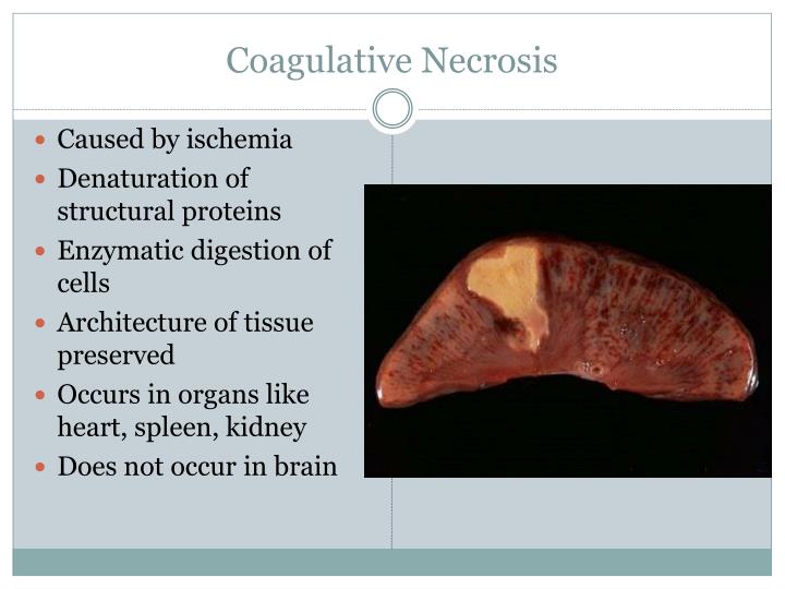 PPT - Necrosis PowerPoint Presentation - ID:3115052