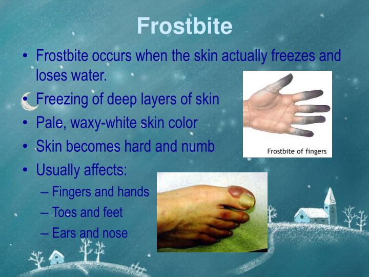 PPT - Cold Stress PowerPoint Presentation - ID:3116329