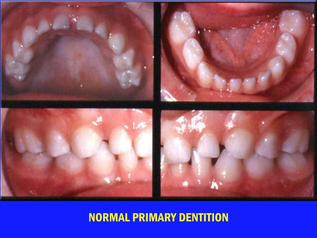 PPT - EARLY CHILDHOOD CARIES: ORAL HEALTH PROMOTION BEGINNING WITH MOM ...