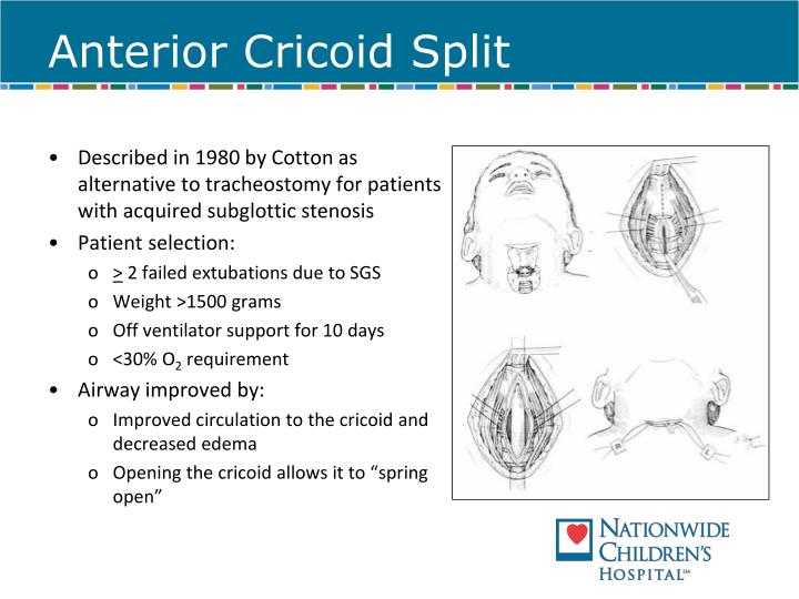 PPT - Acquired Subglottic Stenosis PowerPoint Presentation - ID:3119254