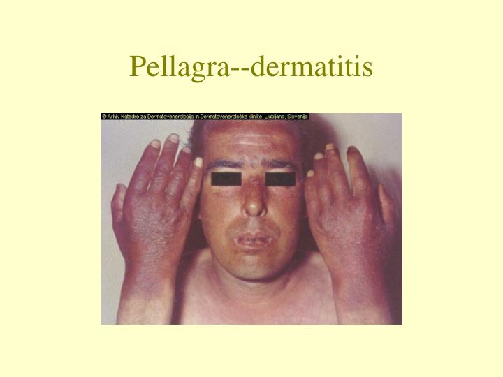 PPT - Pellagra PowerPoint Presentation - ID:3124049