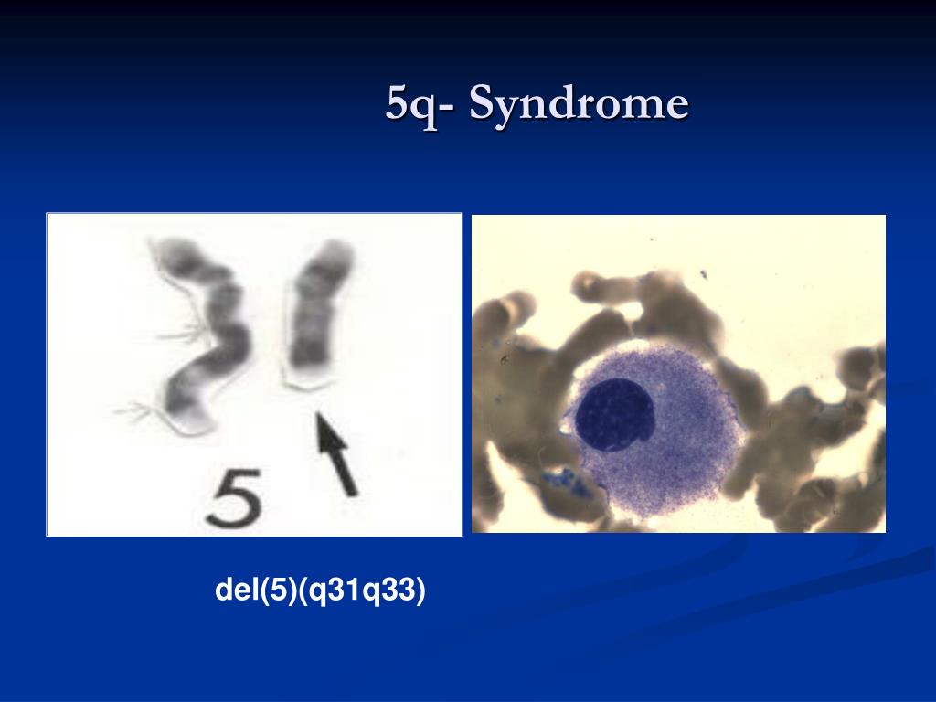 PPT - Current Treatments in MDS; the Scottish Perspective PowerPoint ...