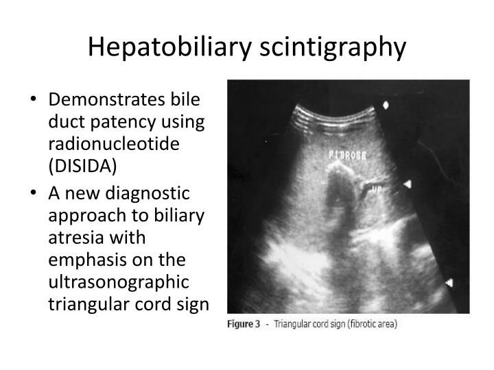 PPT - Biliary Atresia PowerPoint Presentation - ID:3125670