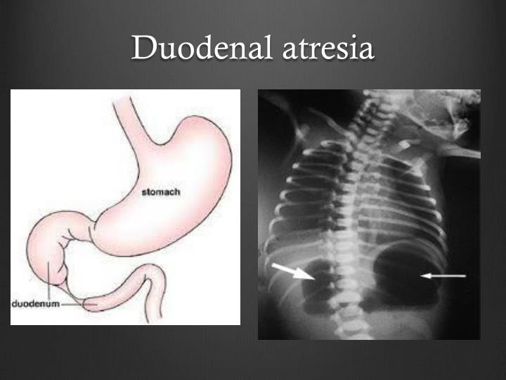 PPT - Pediatric GI Shilpa Singh PowerPoint Presentation - ID:3125988