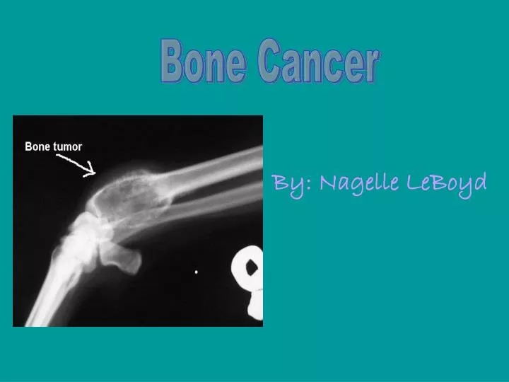 PPT - Bone Cancer PowerPoint Presentation, free download - ID:3127241