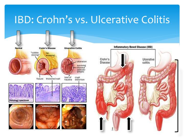 PPT - Nutritional Management of Crohn’s Disease PowerPoint Presentation ...