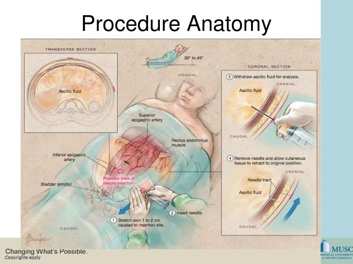 PPT - Paracentesis PowerPoint Presentation - ID:3131011