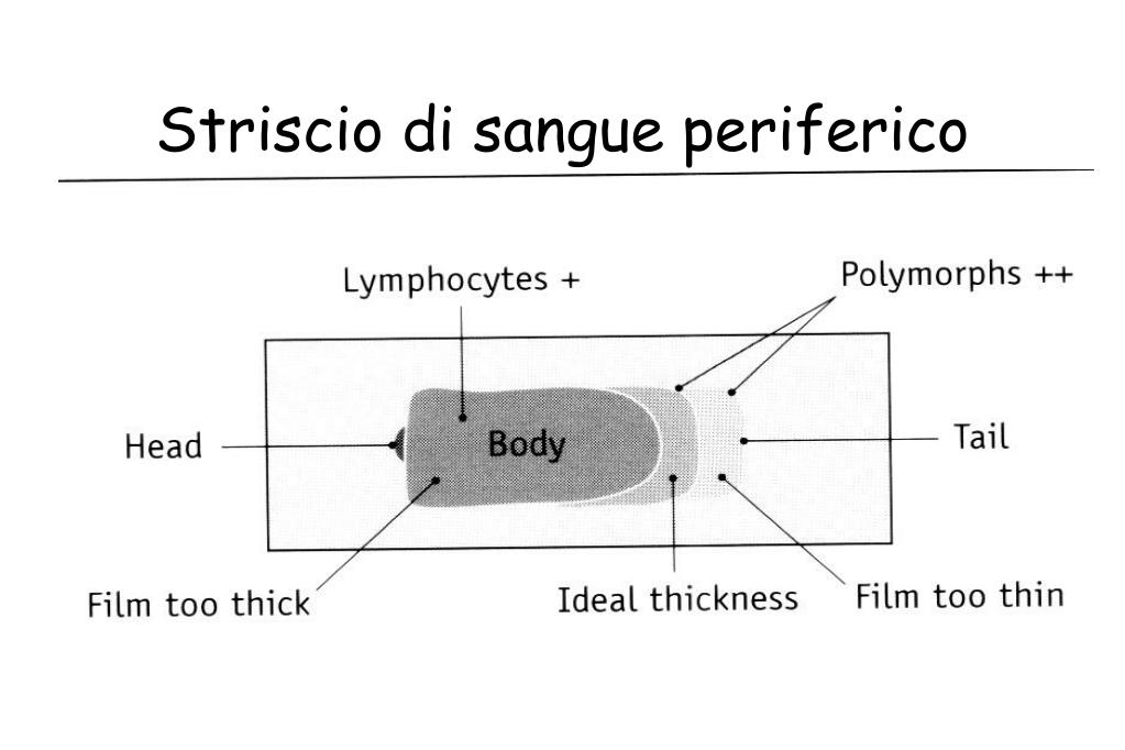 PPT - Corso di Ematologia Dr. Mario Tiribelli Clinica Ematologica ...