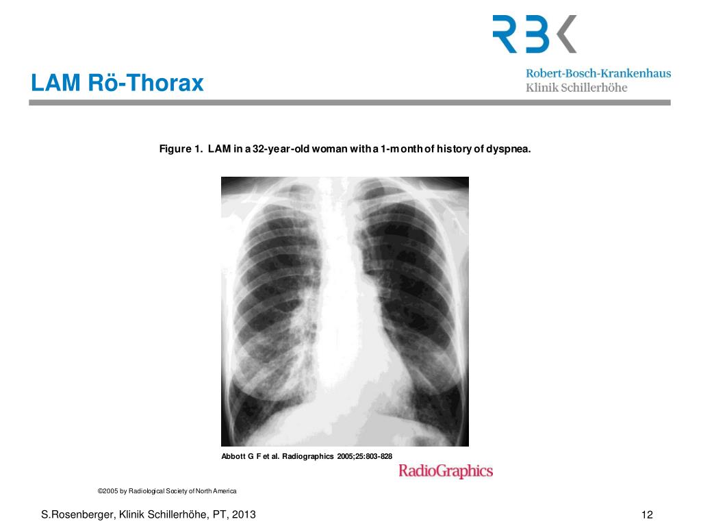 PPT - Lymphangioleiomyomatose (LAM) Physiotherapie bei LAM Stefanie ...