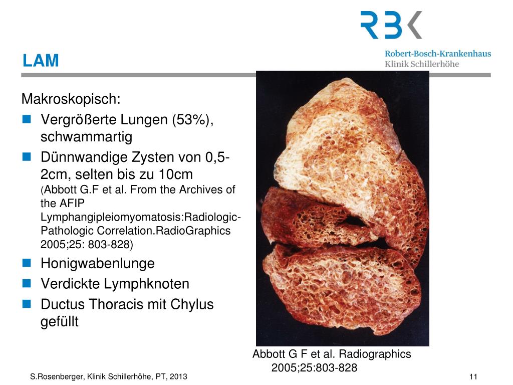 PPT - Lymphangioleiomyomatose (LAM) Physiotherapie bei LAM Stefanie ...