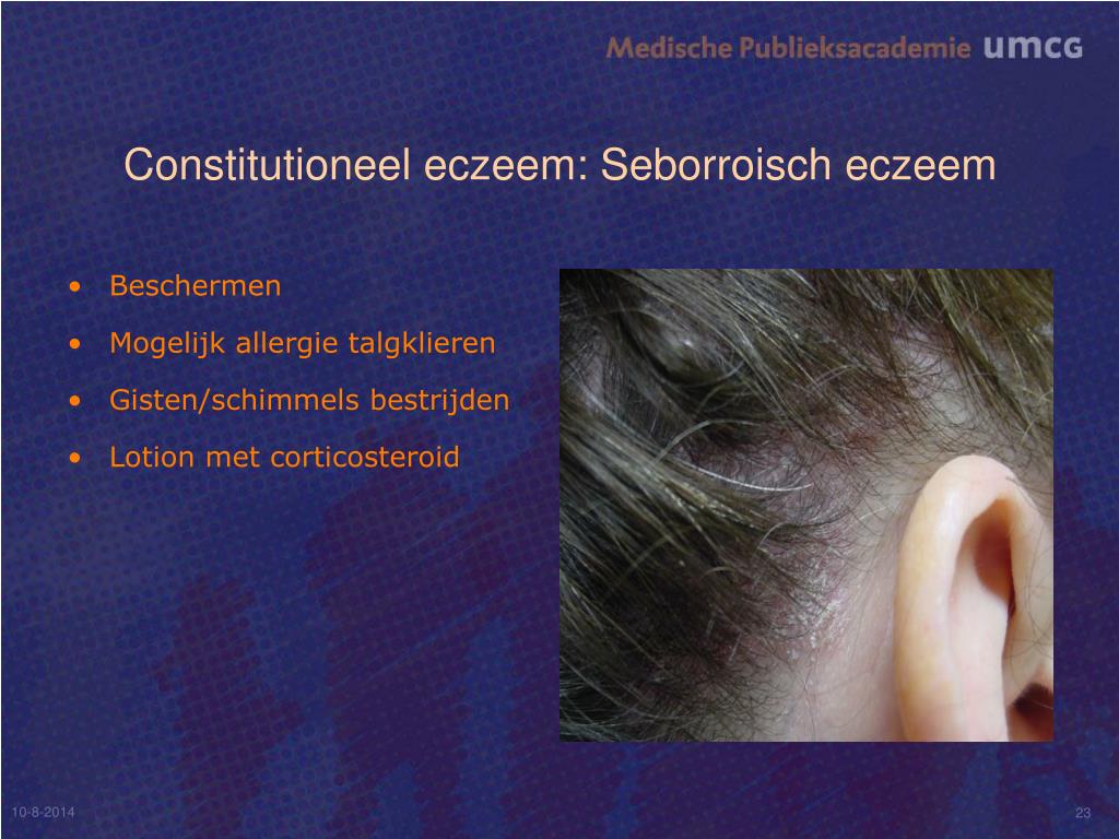 PPT - Eczeem wat nu? Diagnose en behandeling Mythes en werkelijkheid ...