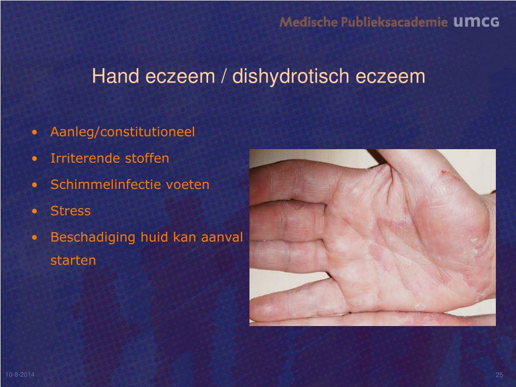 PPT - Eczeem wat nu? Diagnose en behandeling Mythes en werkelijkheid ...