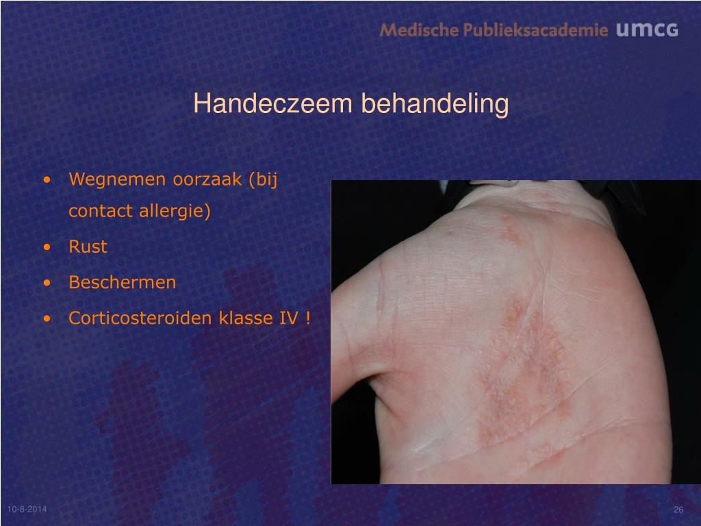 PPT - Eczeem wat nu? Diagnose en behandeling Mythes en werkelijkheid ...