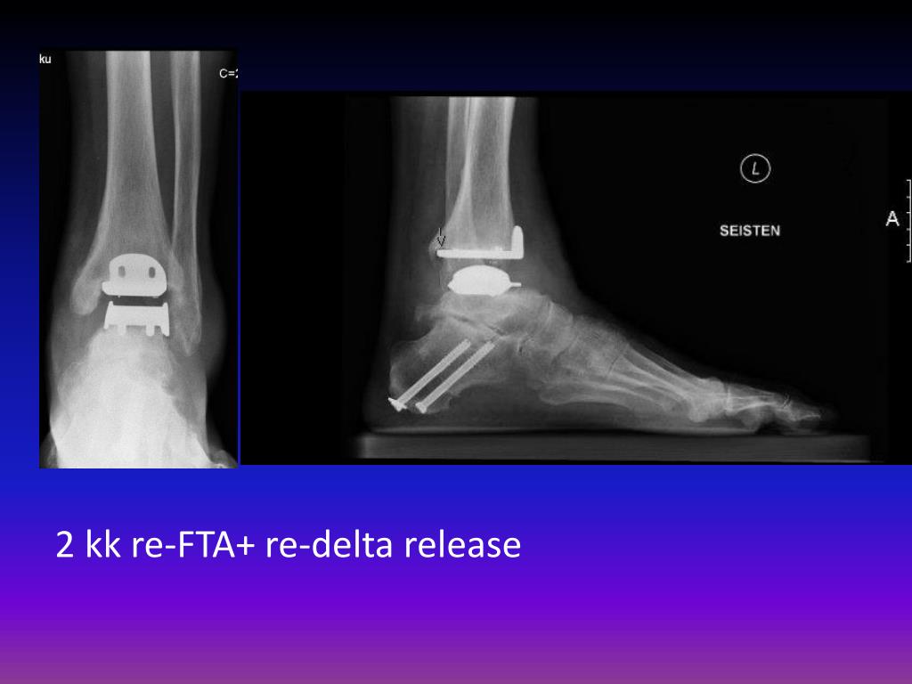 PPT - Nilkkaproteesi Total Ankle Arthroplasty = TAA PowerPoint ...