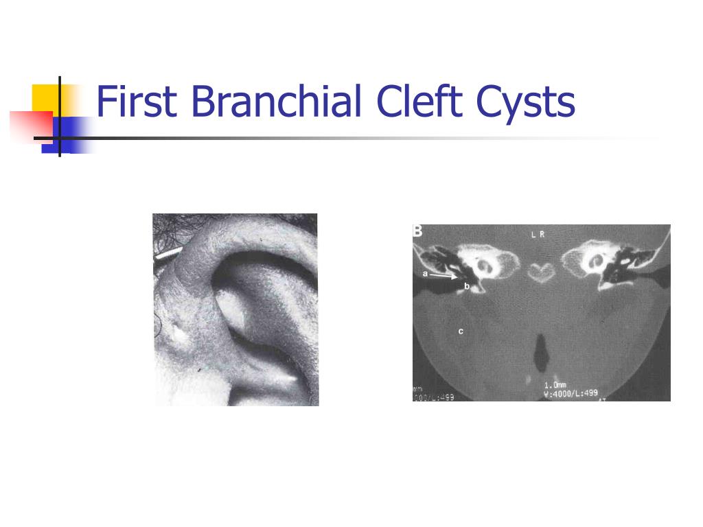 PPT - Embryology of the Neck & Neck Masses PowerPoint Presentation - ID ...
