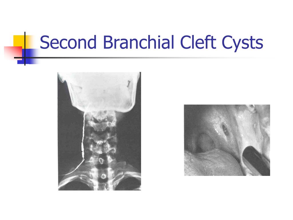 PPT - Embryology of the Neck & Neck Masses PowerPoint Presentation - ID ...