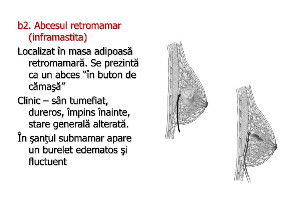 PPT - PATOLOGIA CHIRURGICALĂ A SÂNULUI PowerPoint Presentation, free ...